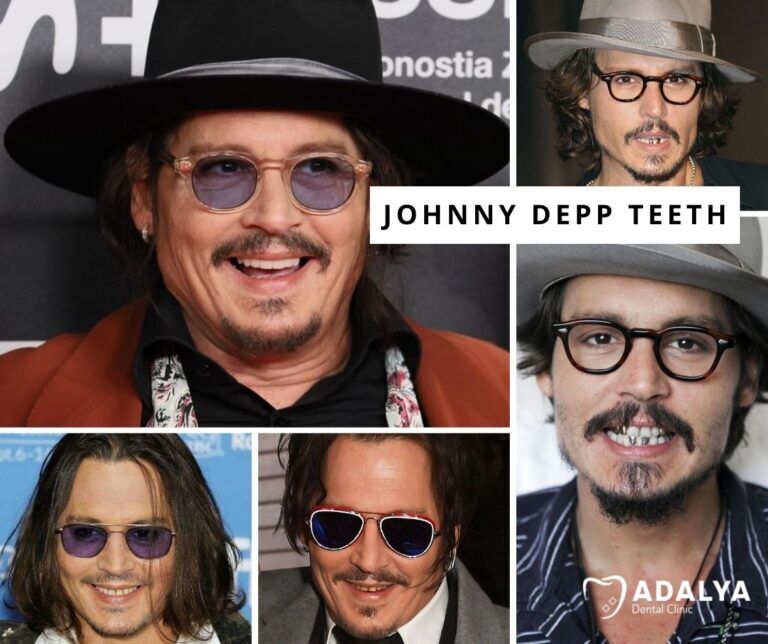 Johnny Depp Teeth: New, Rotting, Before & After Teeth Journey