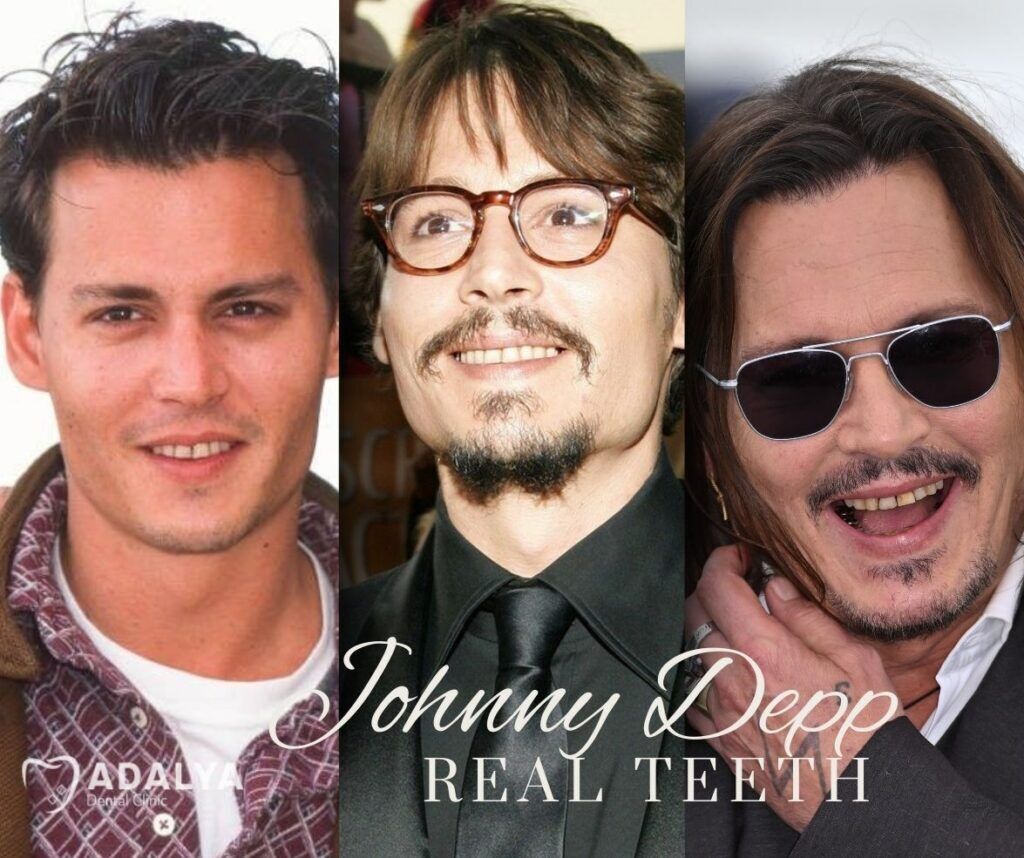Johnny Depp Teeth: New, Rotting, Before & After Teeth Journey