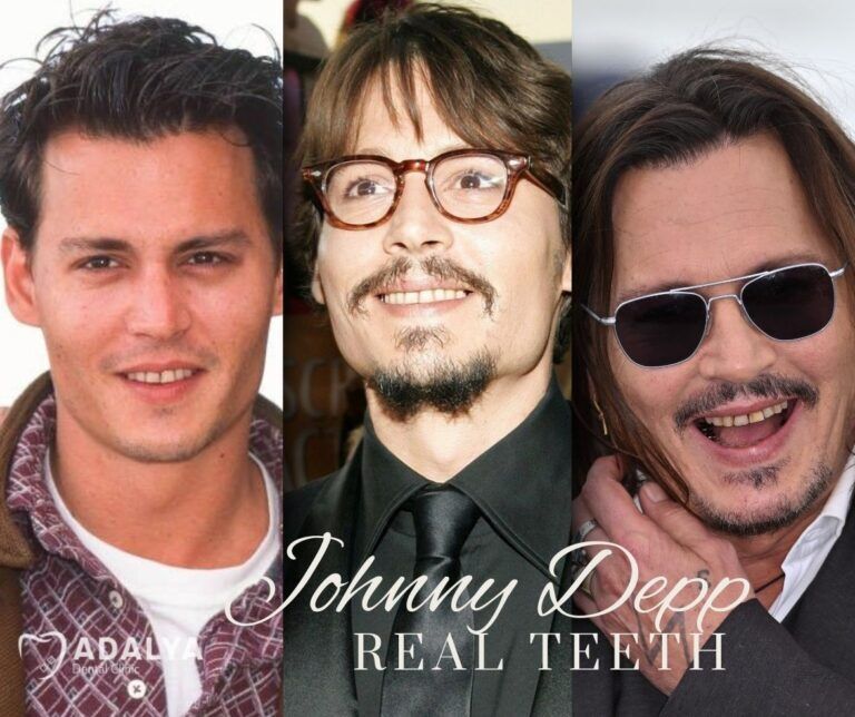 Johnny Depp Teeth: New, Rotting, Before & After Teeth Journey