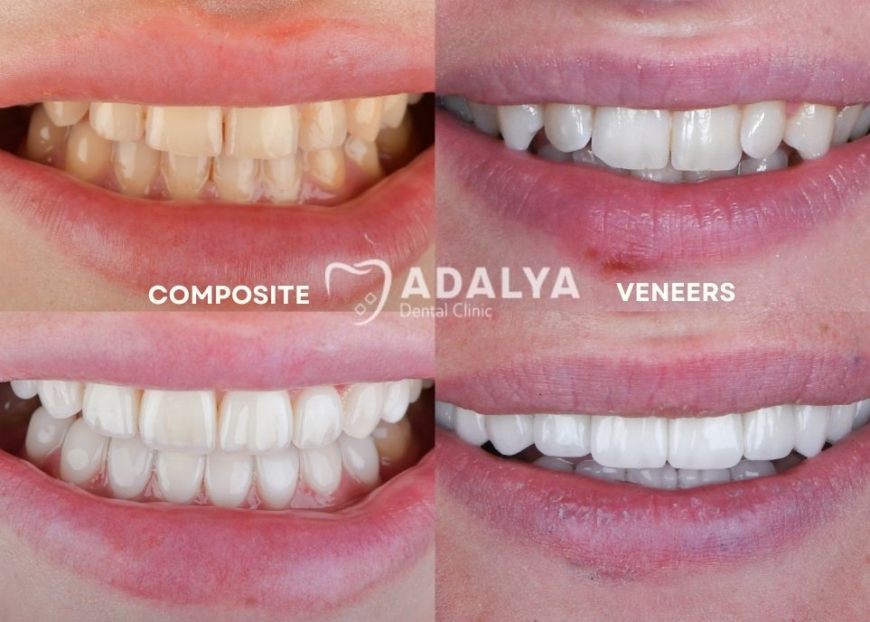 Composite Bonding vs Veneers: Key Differences For Teeth