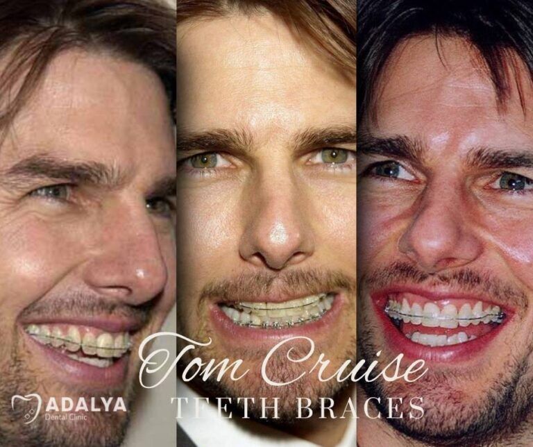 Tom Cruise Teeth: Before and After Journey, Teeth Line Problem