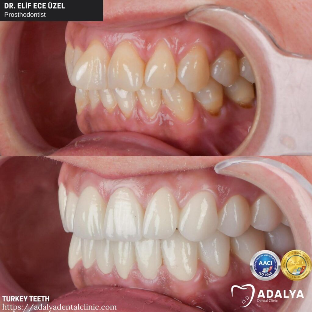 Cost of Turkey Teeth 2025 | Single & Full Set Teeth Prices, Reviews