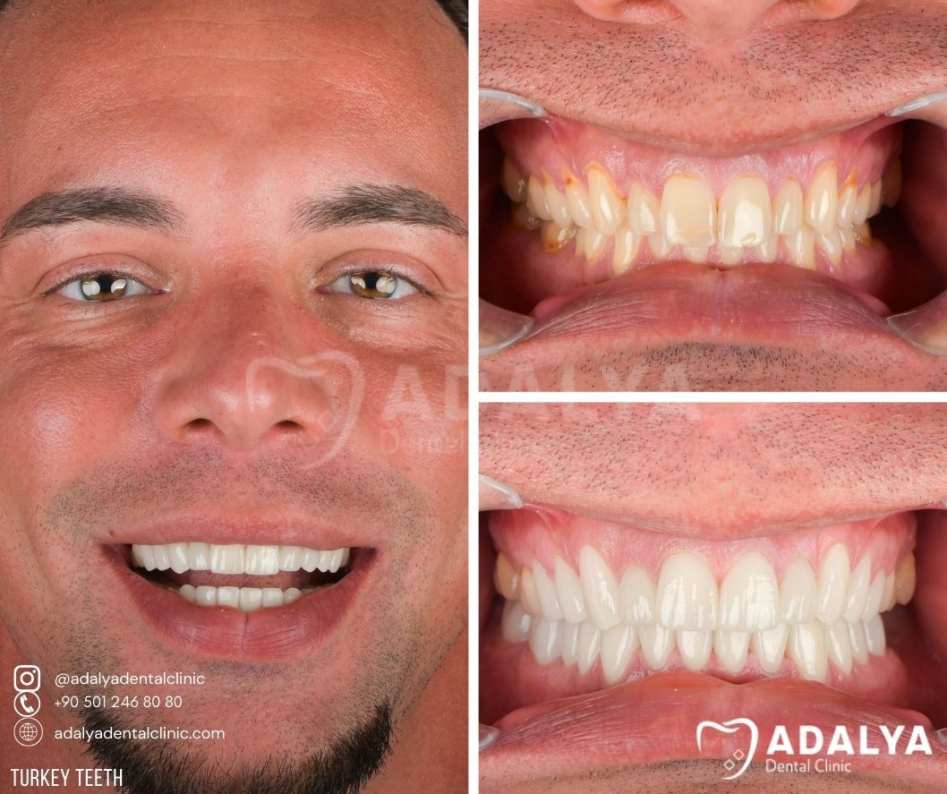 Cost of Turkey Teeth 2025 | Single & Full Set Teeth Prices, Reviews