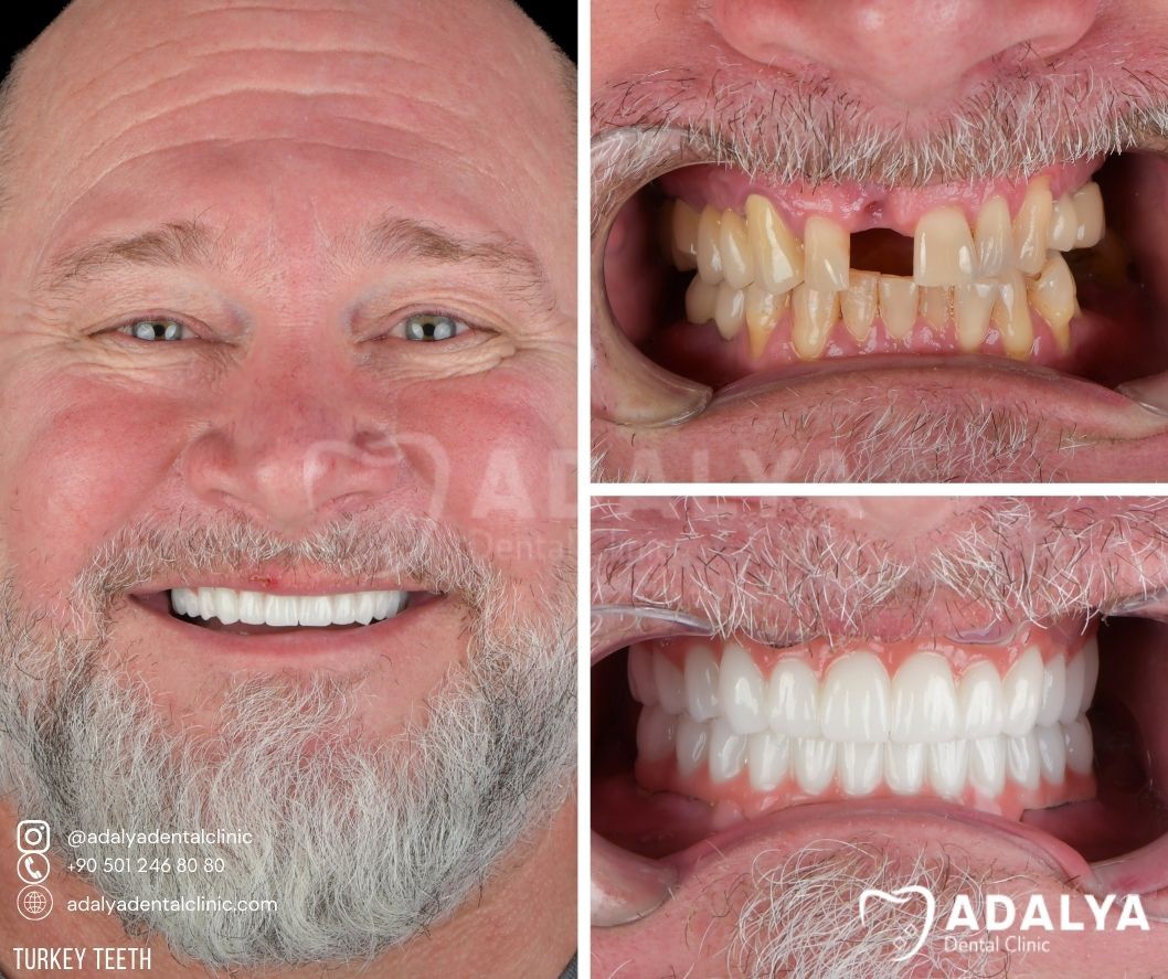 Cost of Turkey Teeth 2025 | Single & Full Set Teeth Prices, Reviews