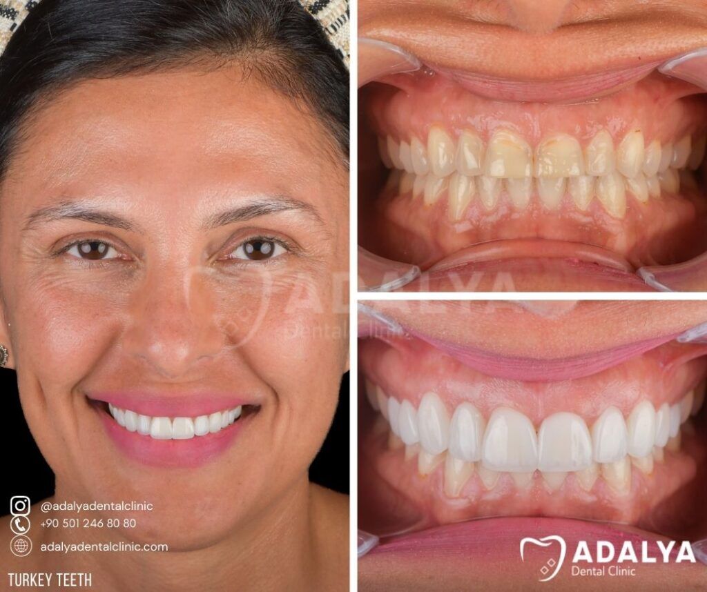 Turkey Teeth Veneers Before and After | Adalya Dental Clinic