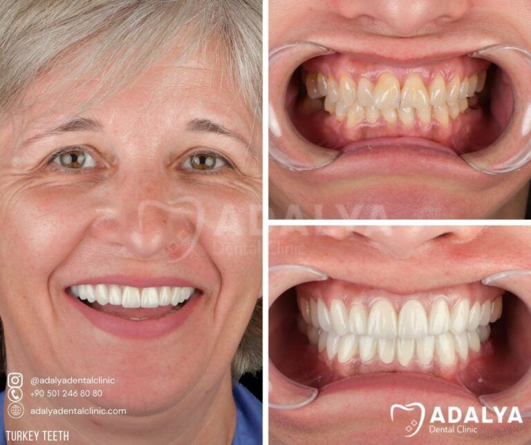 Cost of Turkey Teeth 2025 | Single & Full Set Teeth Prices, Reviews