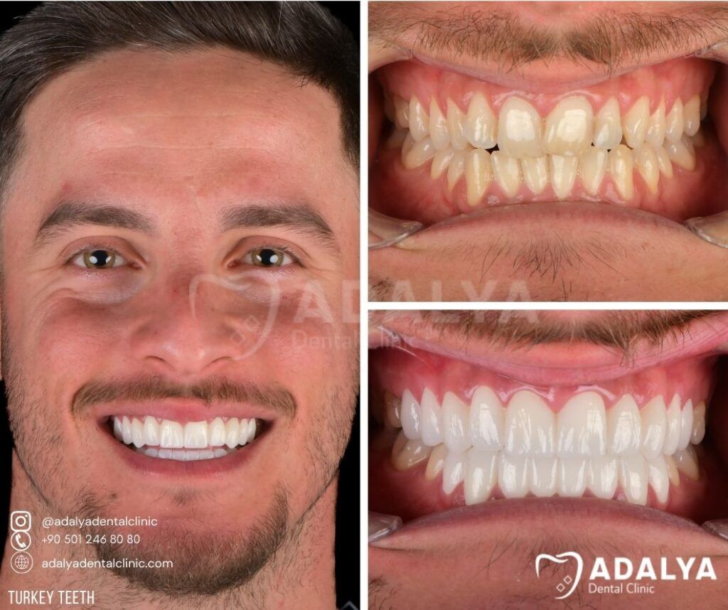 Cost of Turkey Teeth 2025 | Single & Full Set Teeth Prices, Reviews